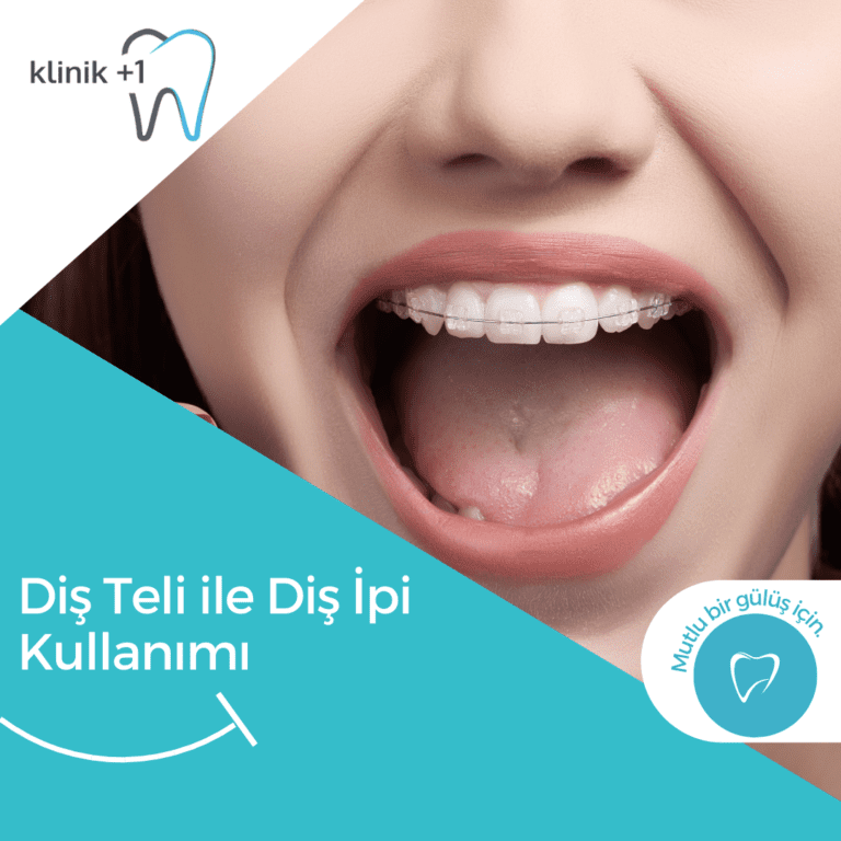 Diş Teli ile Diş İpi Kullanımı